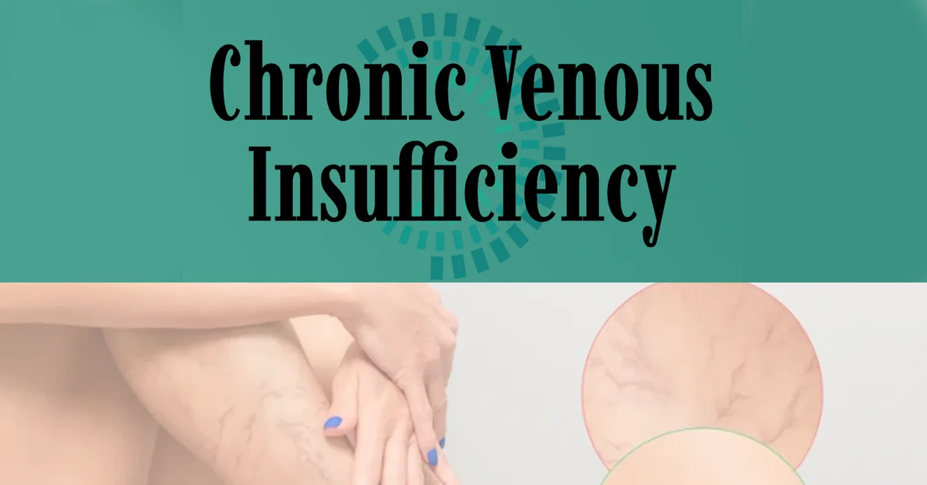 Chronic Venous Insufficiency - Diagnosis and Treatments